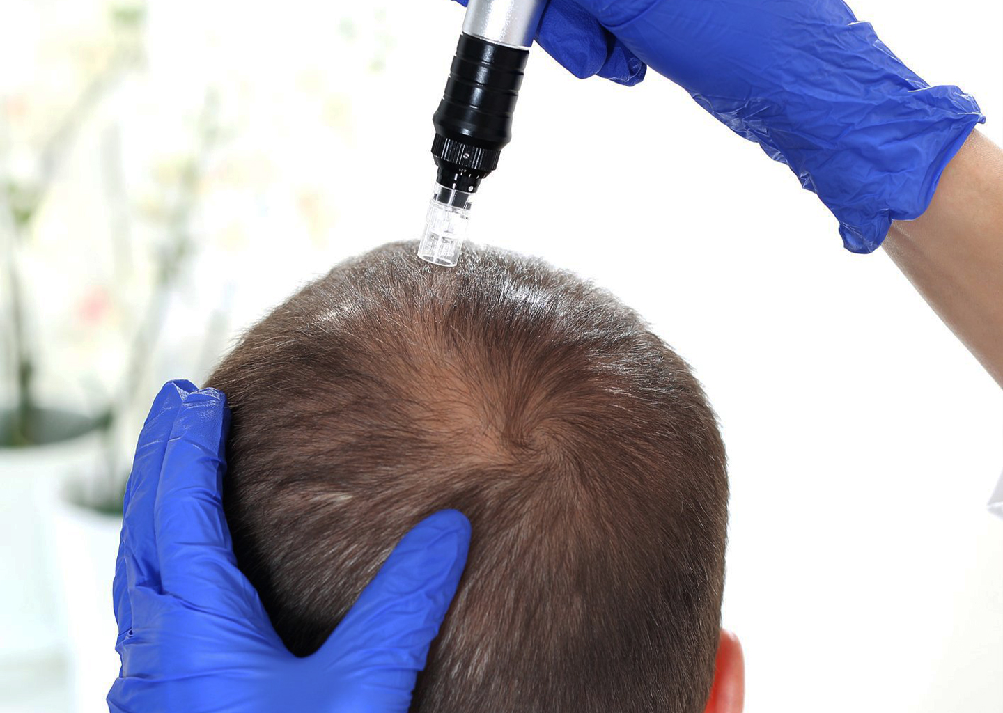 Microneedling for Hairlines - gesund - integrative health, wellness ...